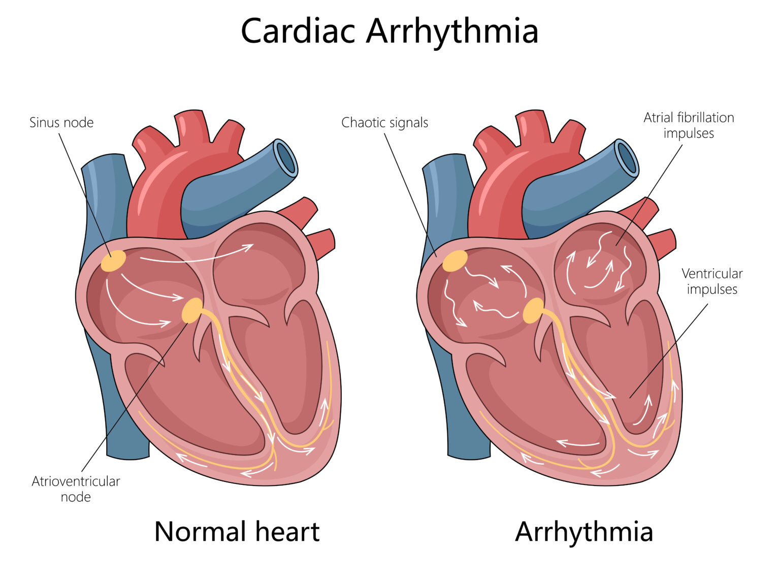 Effective Causes & Treatment for Heart Arrhythmia - CVG Cares ...