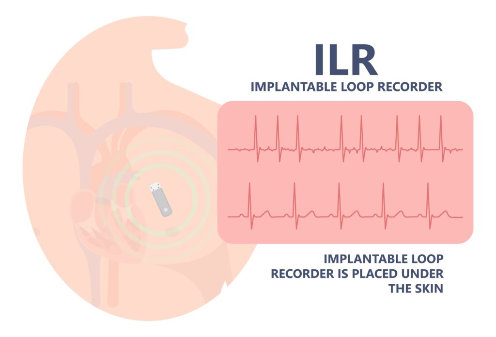 Implantable Loop Recorder - Detailed Condition Information | CVG Cares Cardiology - CVG